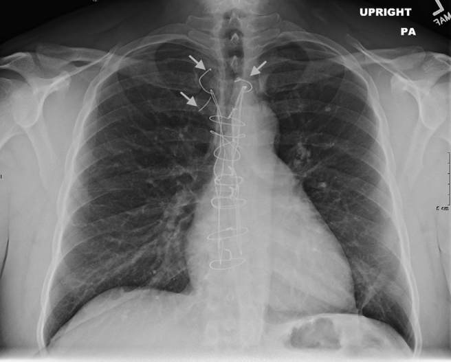 Half a million x-rays! First impressions of the Stanford and MIT chest ...