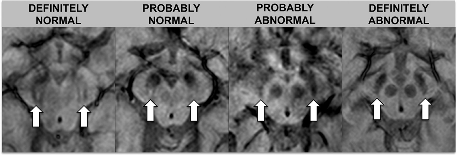 The FDA has approved AI-based PET/MRI “denoising”. How safe is this ...